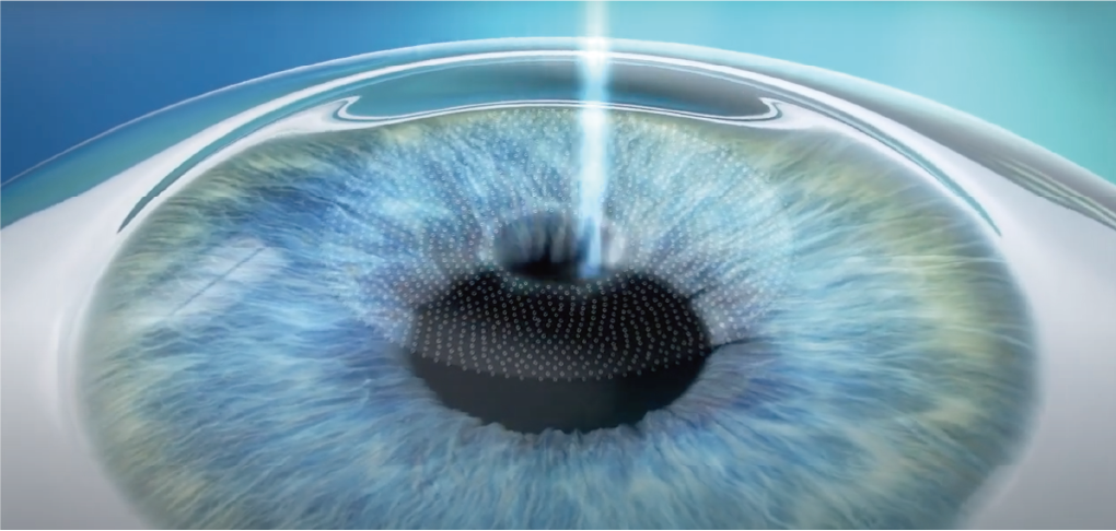 SMILE Pro 2.0全飛秒近視雷射10秒擺脫眼鏡束縛 - 遠見眼科